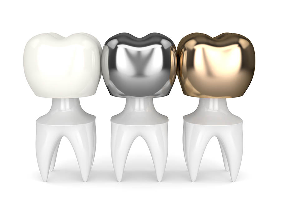 Crowns (Caps) - Richmond Dentist Dr. Robert Oliveros DMD