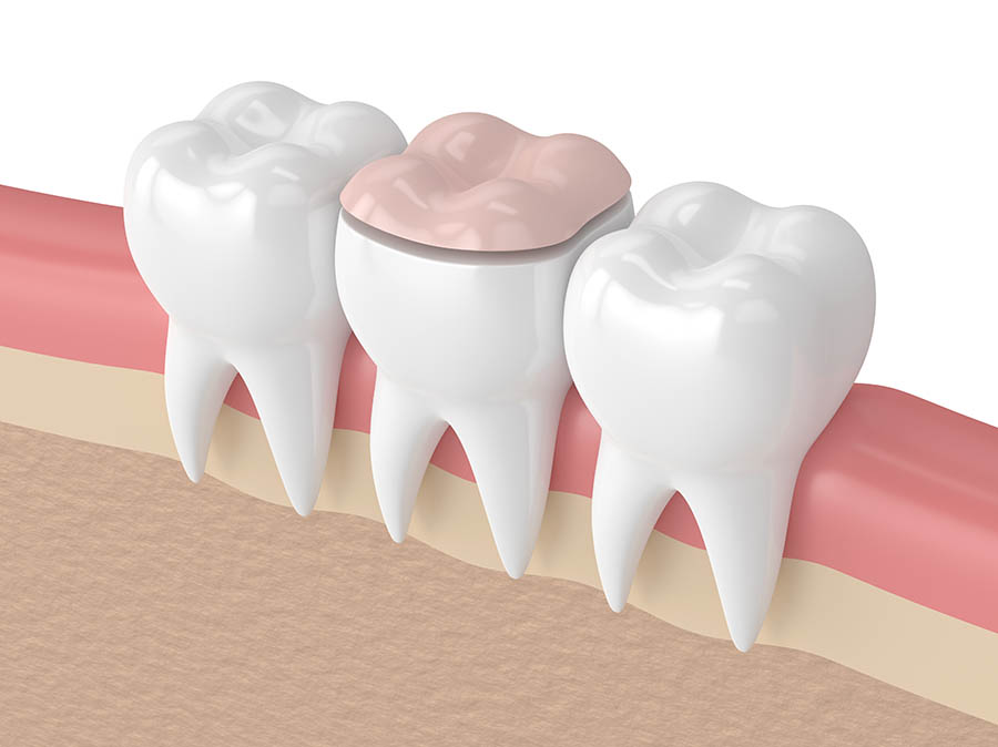 Inlays/Onlays - Richmond Dentist Dr. Robert Oliveros DMD